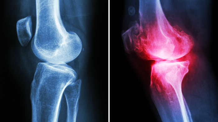 Arthritis Explained: What’s Happening Inside Your Joints — Science of ...