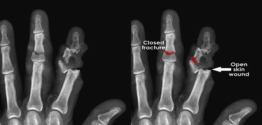 Understanding Bone Fractures — Science of Falling