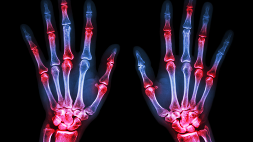 Arthritis Explained: What’s Happening Inside Your Joints — Science of ...