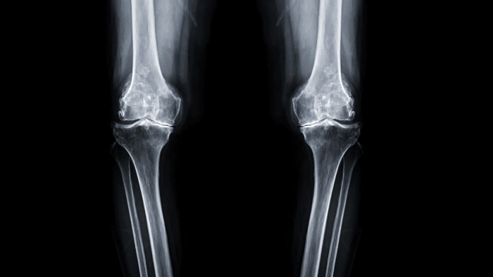 Arthritis Explained: What’s Happening Inside Your Joints — Science of ...