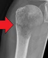 Understanding Bone Fractures — Science of Falling
