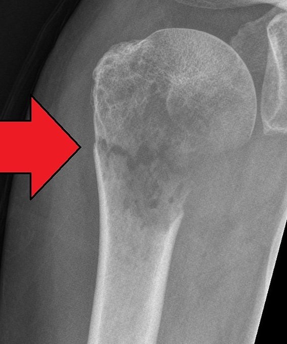 Understanding Bone Fractures — Science of Falling