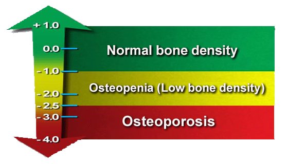 Optimizing Bone Health: Your Complete Guide to Stronger Bones and a ...