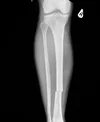 Understanding Bone Fractures — Science of Falling