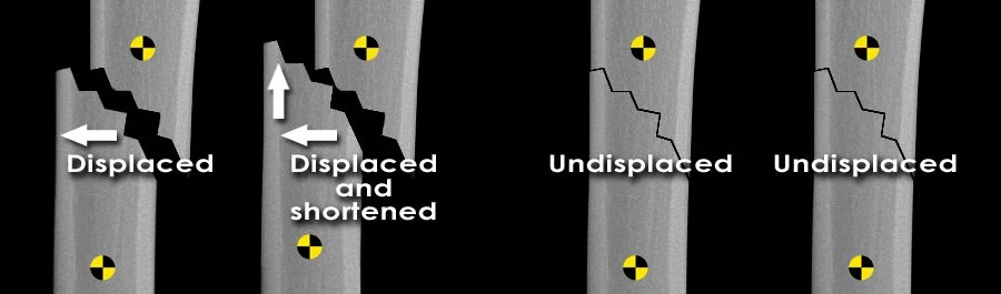 Understanding Bone Fractures — Science of Falling