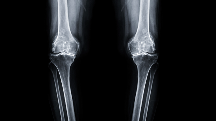 Arthritis Explained: What’s Happening Inside Your Joints — Science of ...