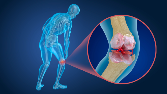Arthritis Explained: What’s Happening Inside Your Joints — Science of ...