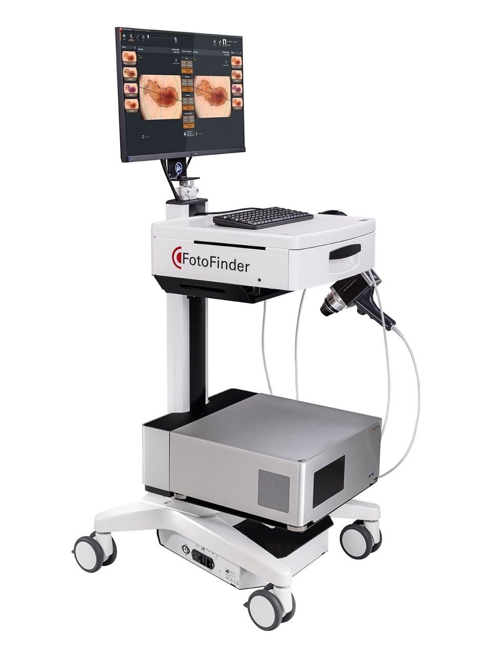 Advanced Mole Mapping in Toronto | Fee $350 | Early Skin Cancer ...