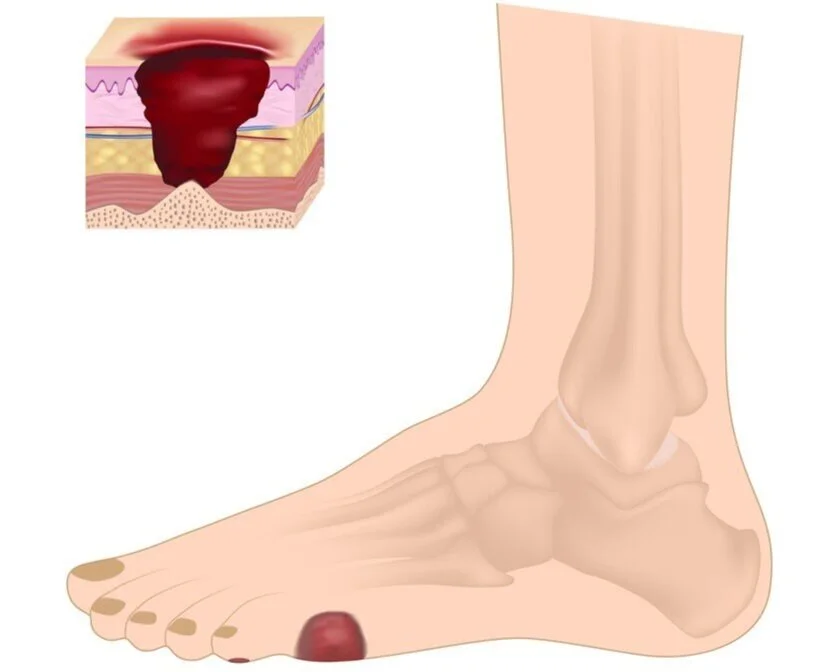 Foot Ulcers & Diabetic Wound Care | Foot Doctor Plantation, FL — DAVID ...