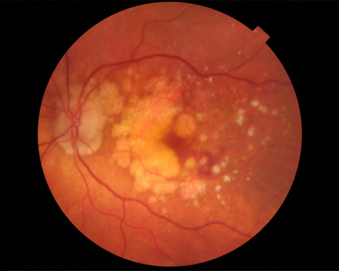 Age-related Macular Degeneration Bristol — Sidath Liyanage ...