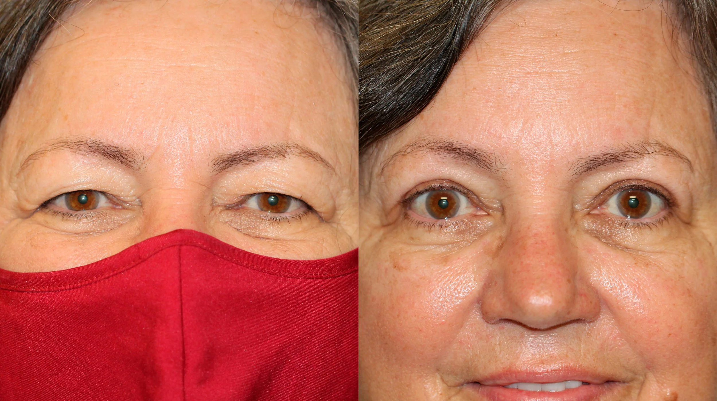 Before and After — Eric Hamill MD | Eye and Face Plastic Surgery