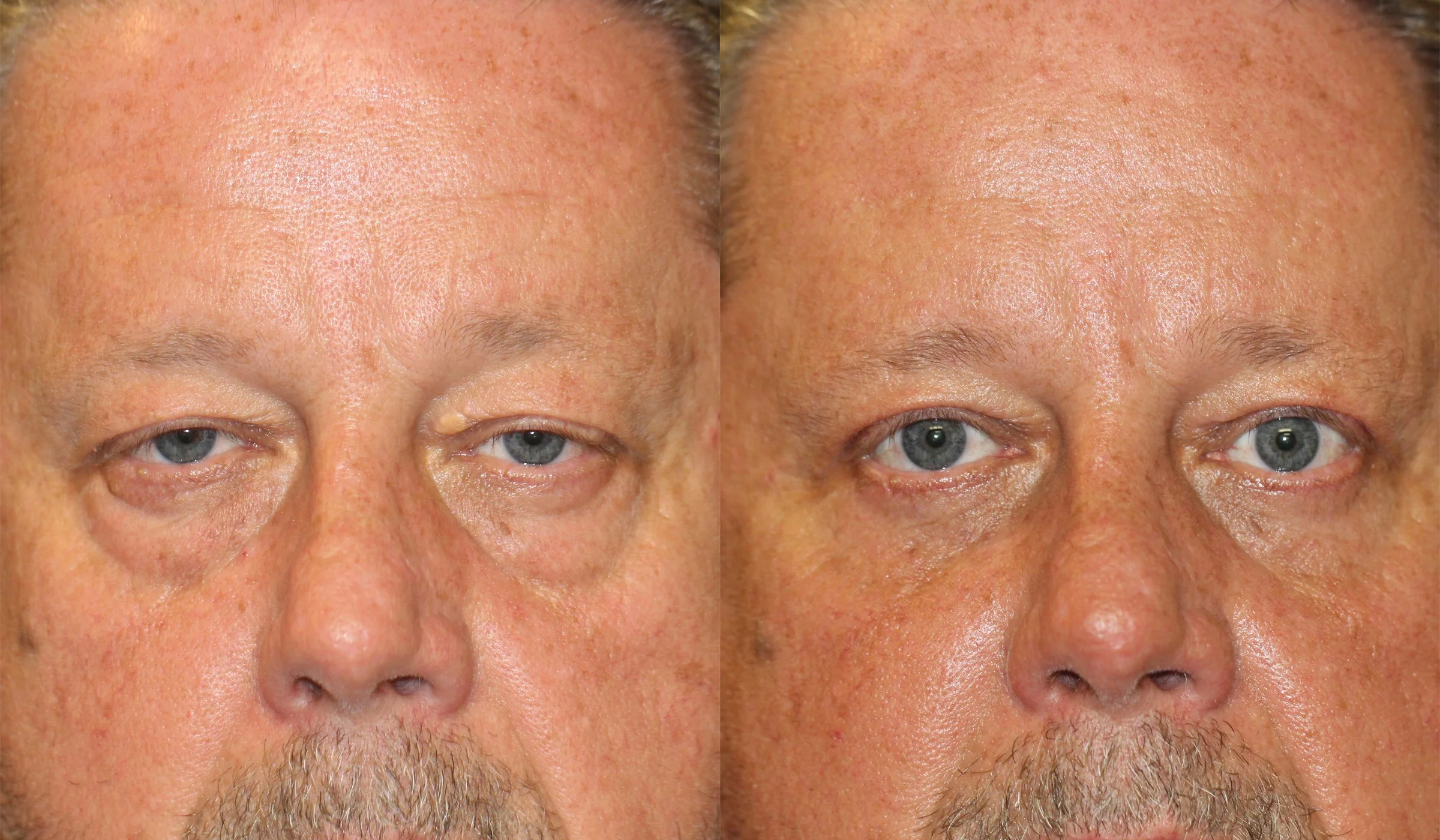 Before and After — Eric Hamill MD | Eye and Face Plastic Surgery