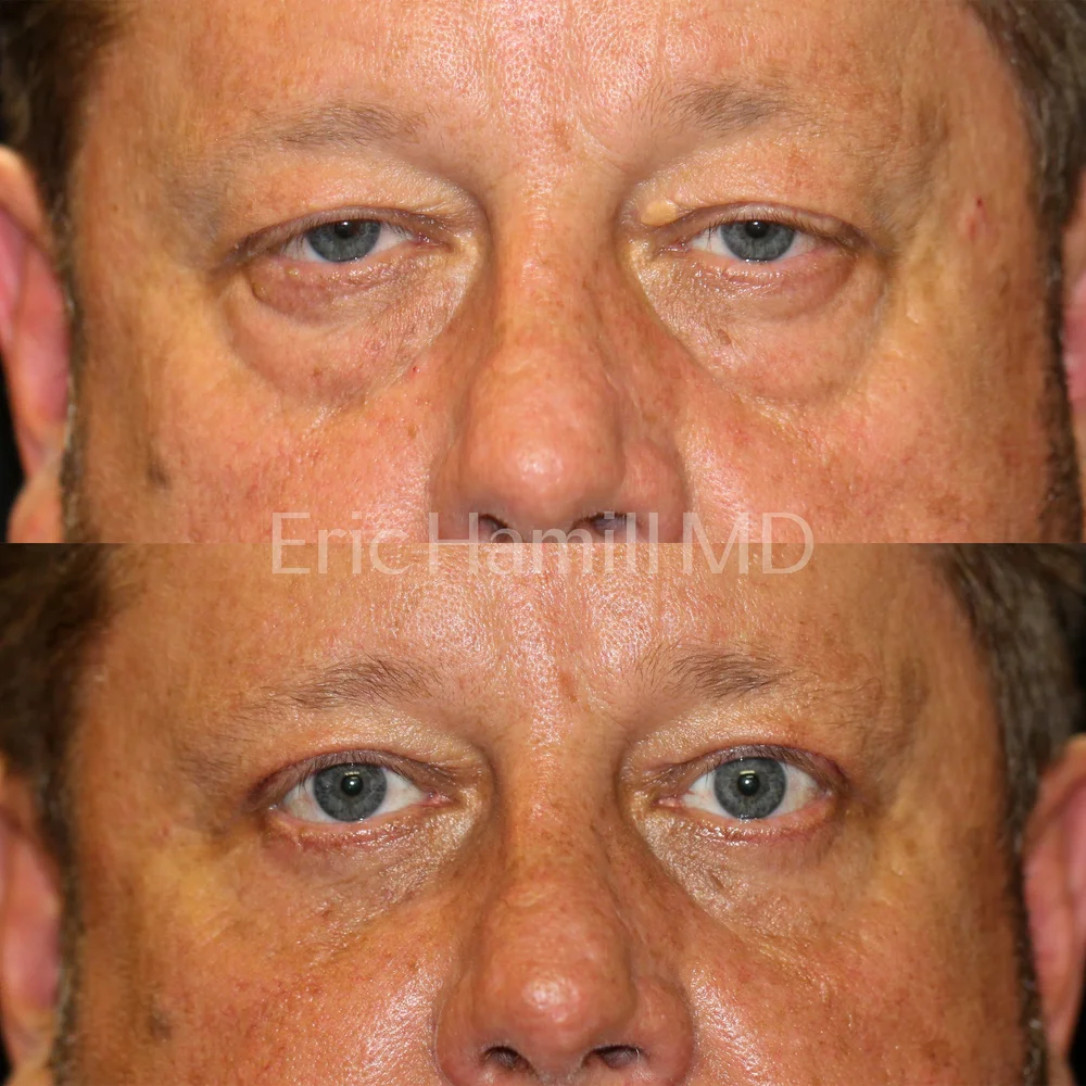 Ptosis (Droopy Eyelid) Surgery — Eric Hamill MD | Eye and Face Plastic ...