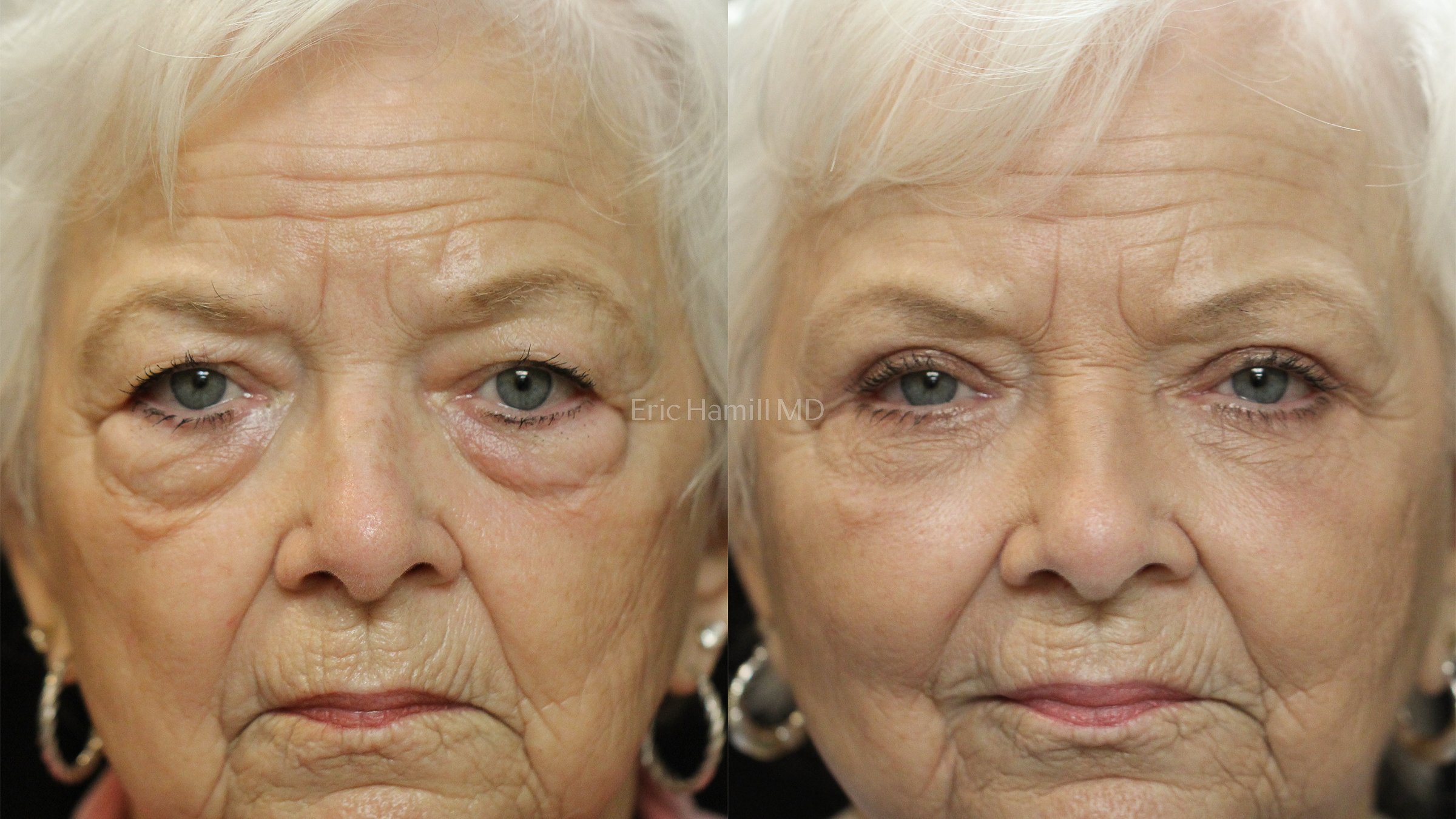 Before and After — Eric Hamill MD | Eye and Face Plastic Surgery