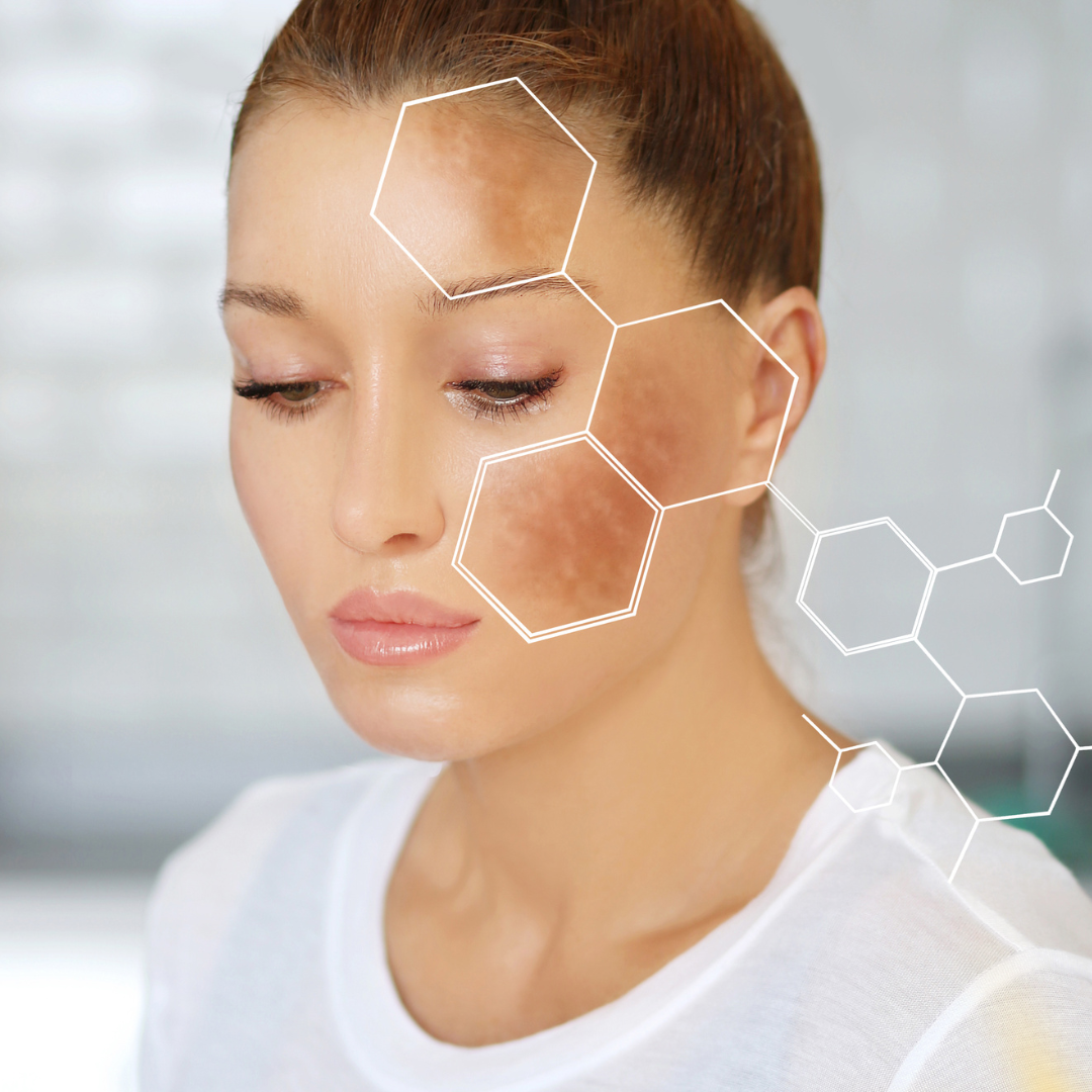MELASMA: What Causes It and How to Treat It for Radiant, Even-Toned ...