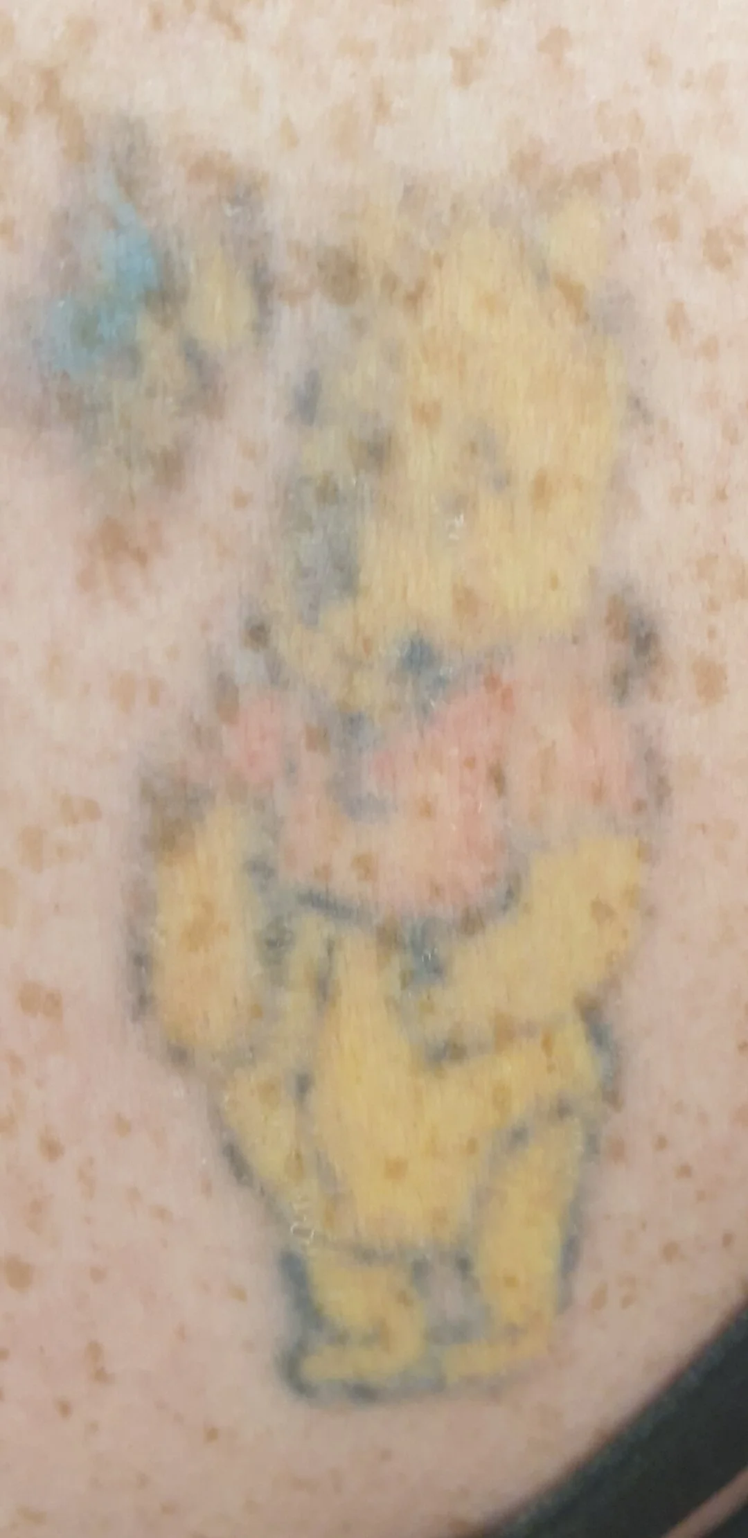 Laser Tattoo Removal — Anubis Piercings