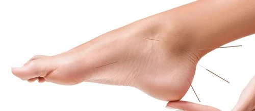 Enhance Sports Recovery with Acupuncture