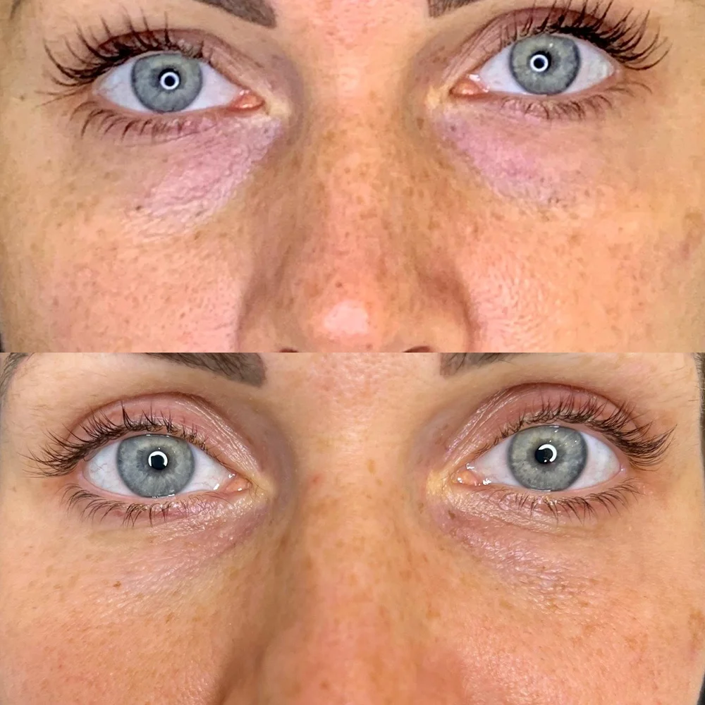 Polynucleotides Skin Treatment | Regenerative Aesthetics at Townhouse ...