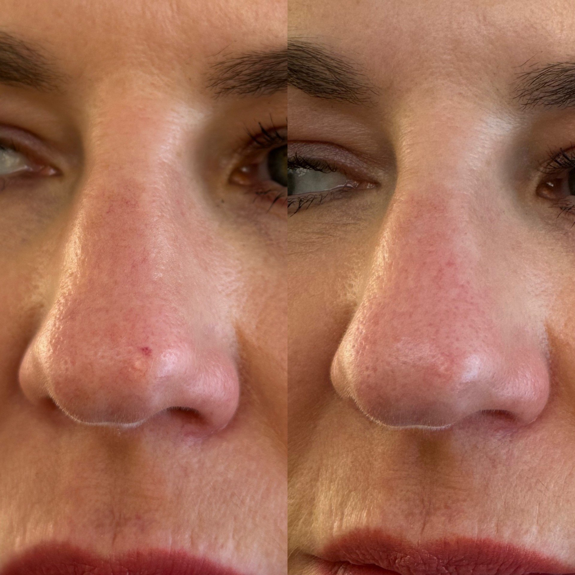 Blemish Removal — The Townhouse Clinic by Dr Lucy - Bath