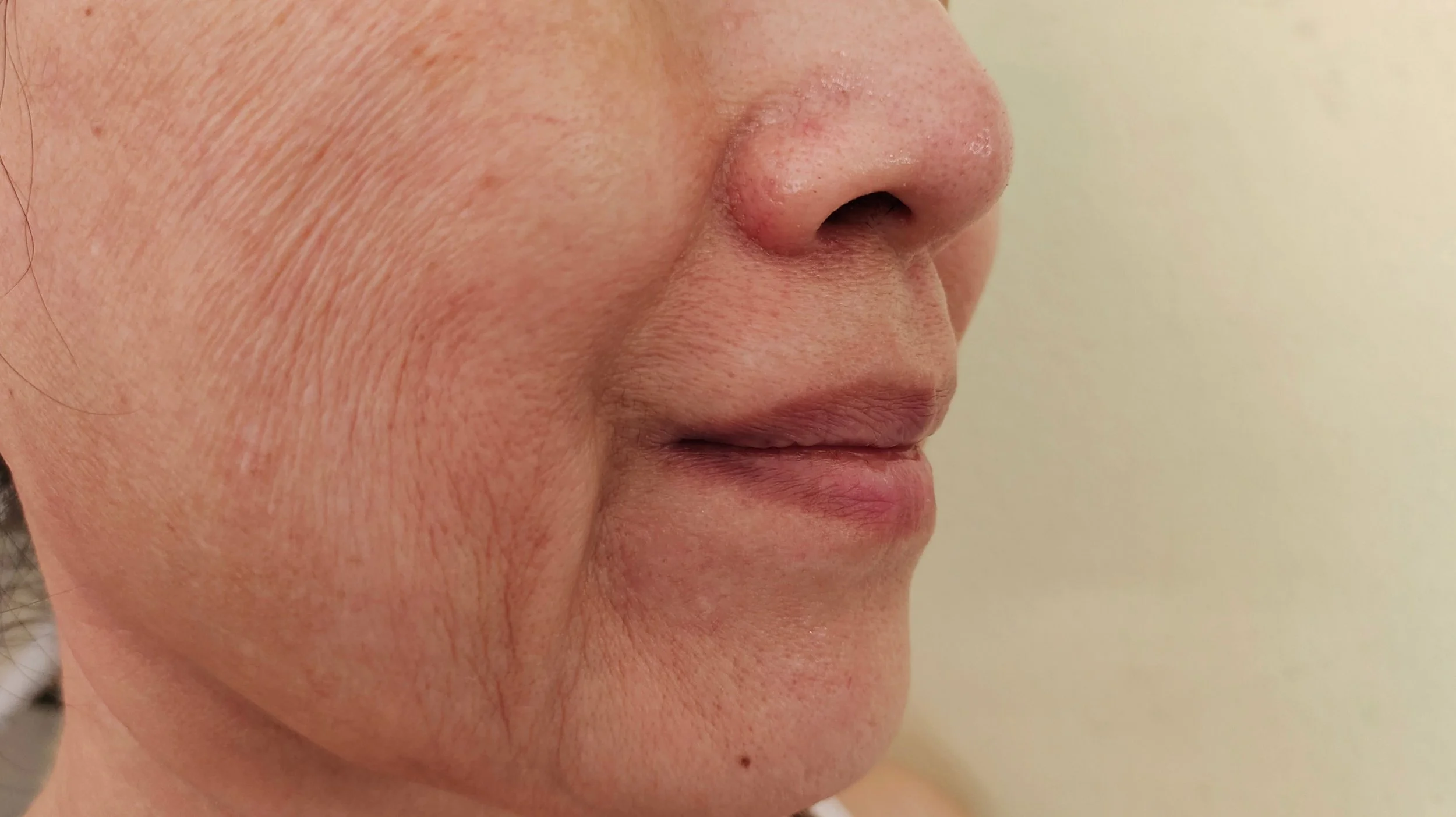Loss of Elasticity — The Townhouse Clinic by Dr Lucy - Bath
