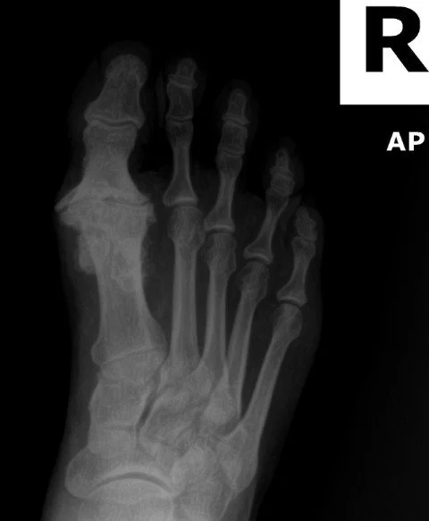 Hallux Rigidus (Big Toe Arthritis) | Causes, Symptoms & Modern ...