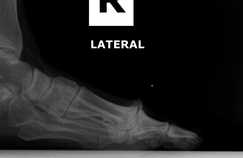 Hallux Rigidus (Big Toe Arthritis) | Causes, Symptoms & Modern ...