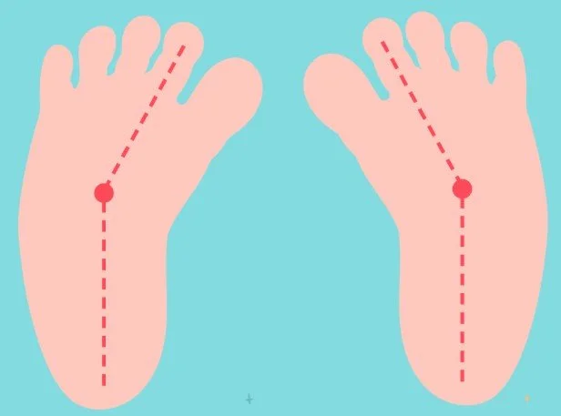 Intoeing In Children: Causes, What Helps, Red Flags — Feet Made Simple