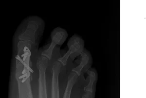 Hallux Rigidus (Big Toe Arthritis) | Causes, Symptoms & Modern ...