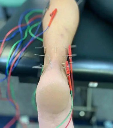 Achilles Tendinopathy: Your Complete Guide to Understanding and Healing ...