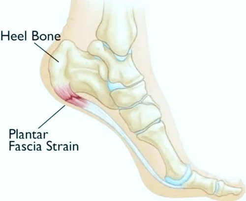 Podiatrist's Plantar Fasciitis Treatment Guide — Feet Made Simple