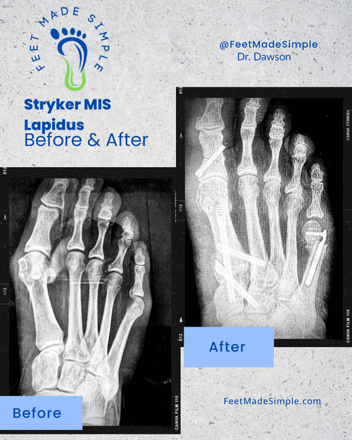 Bunions 2025: Surgery, Recovery & Best Shoes for Relief — Feet Made Simple