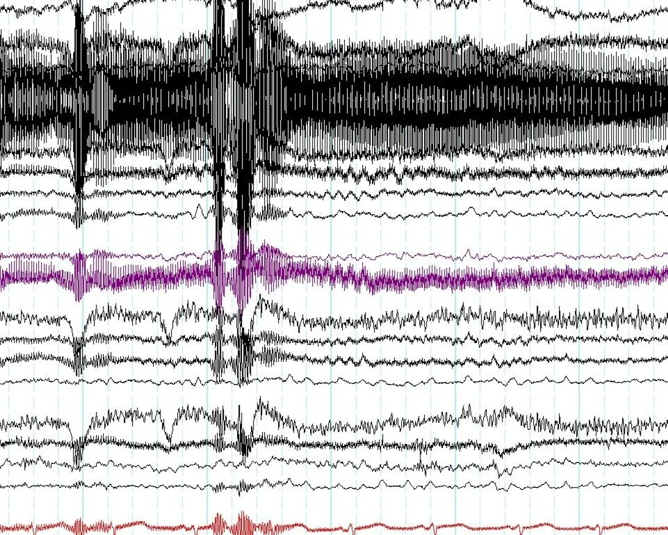 EEG examples — Neurophysiological Sciences Society of Australasia