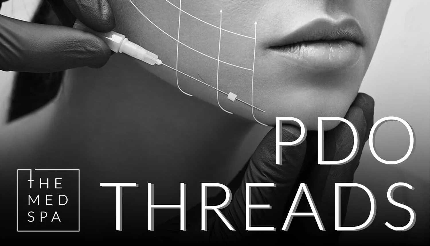 Get a Facelift with PDO Threads in FL — The Med Spa