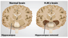 STUDY OF HM — MEMORY | Enhance Memory Skills Today — PSYCHSTORY