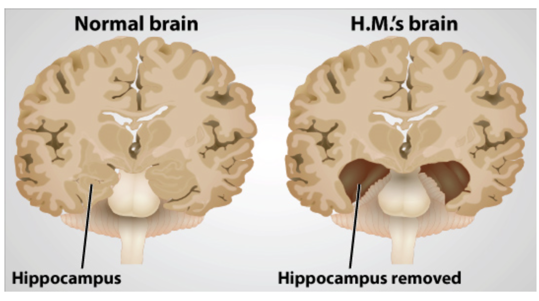 STUDY OF HM — MEMORY | Enhance Memory Skills Today — PSYCHSTORY