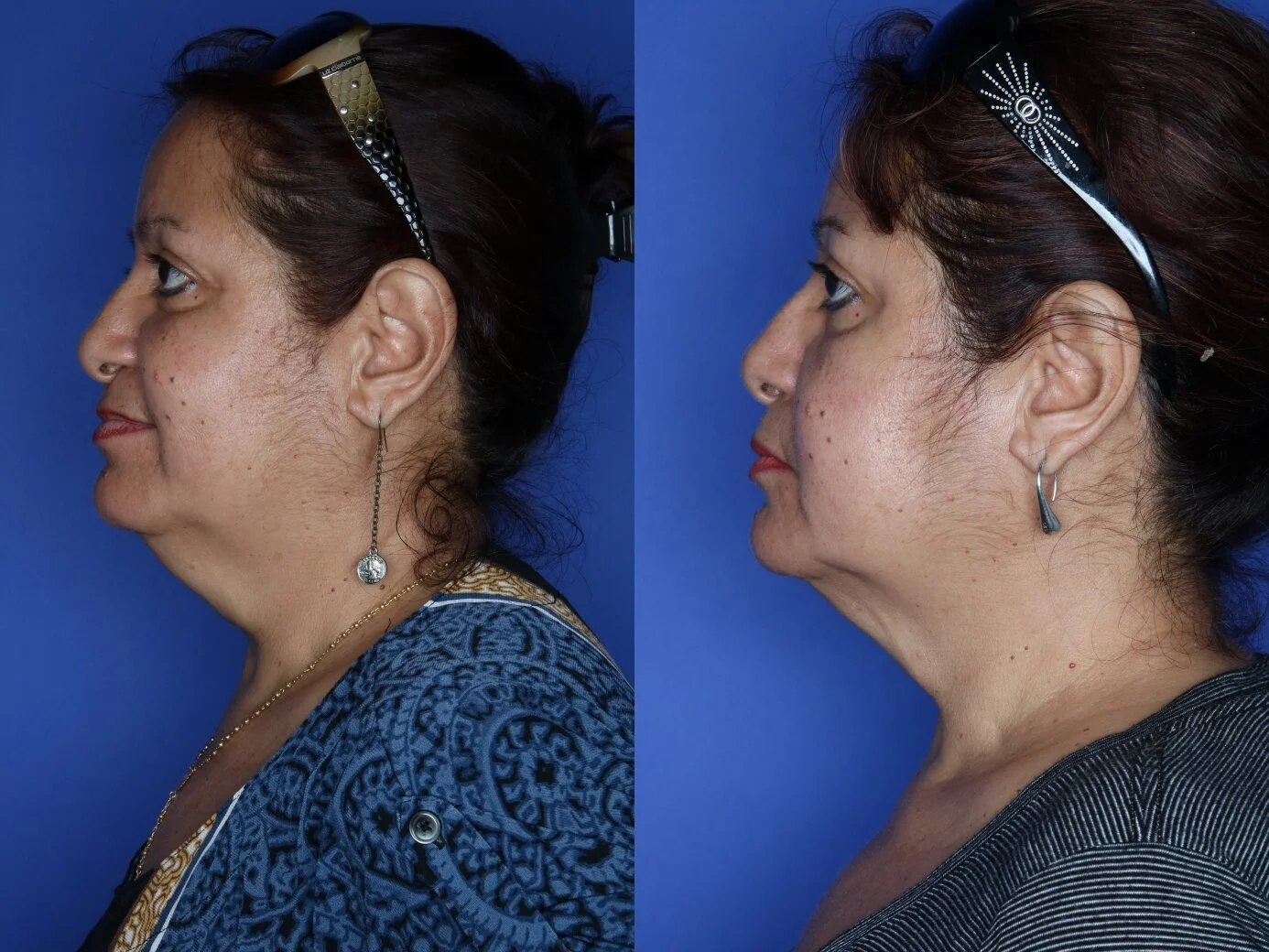 Kybella — Golden Glow Medical Spa