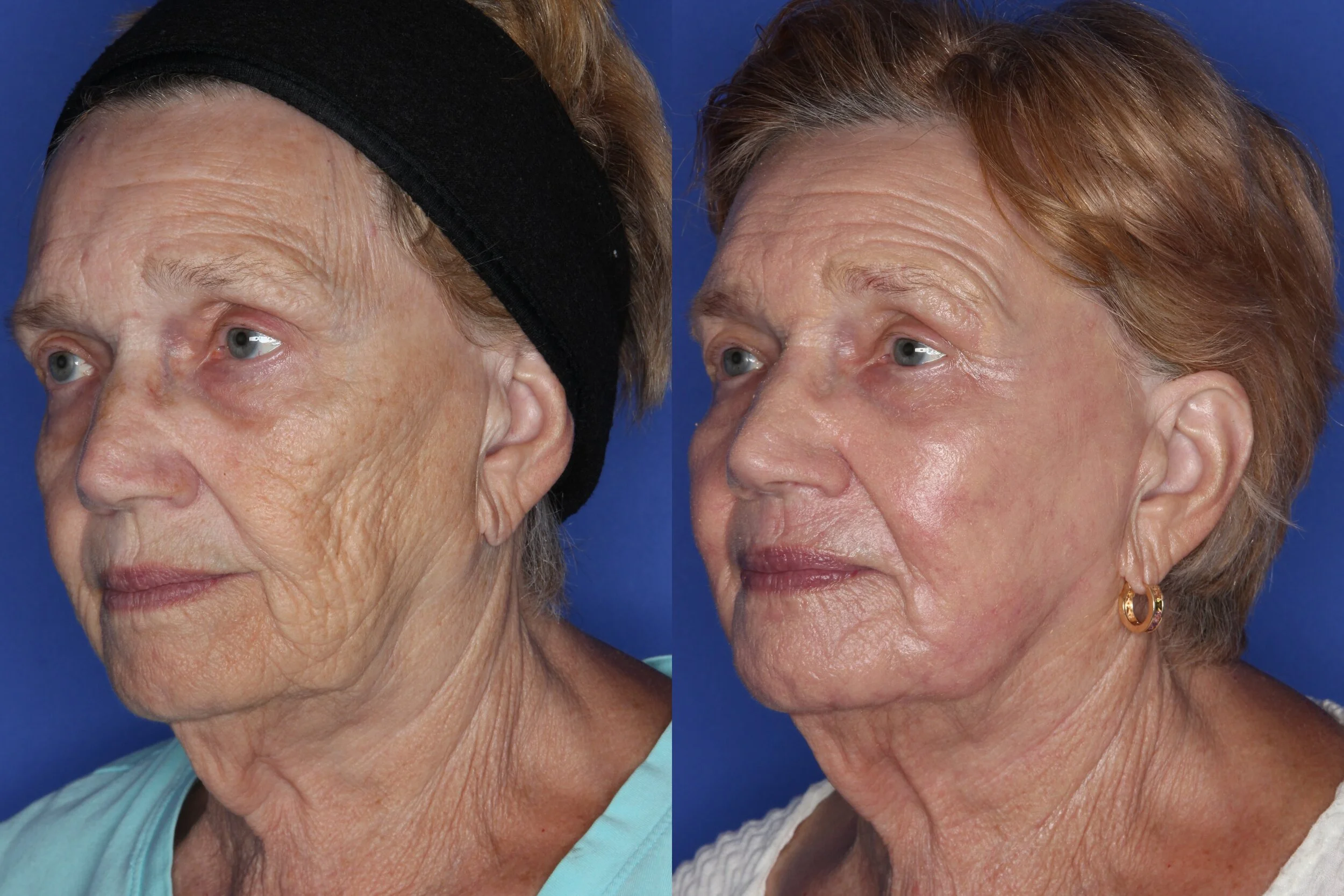 Deep Laser Resurfacing — Golden Glow Medical Spa