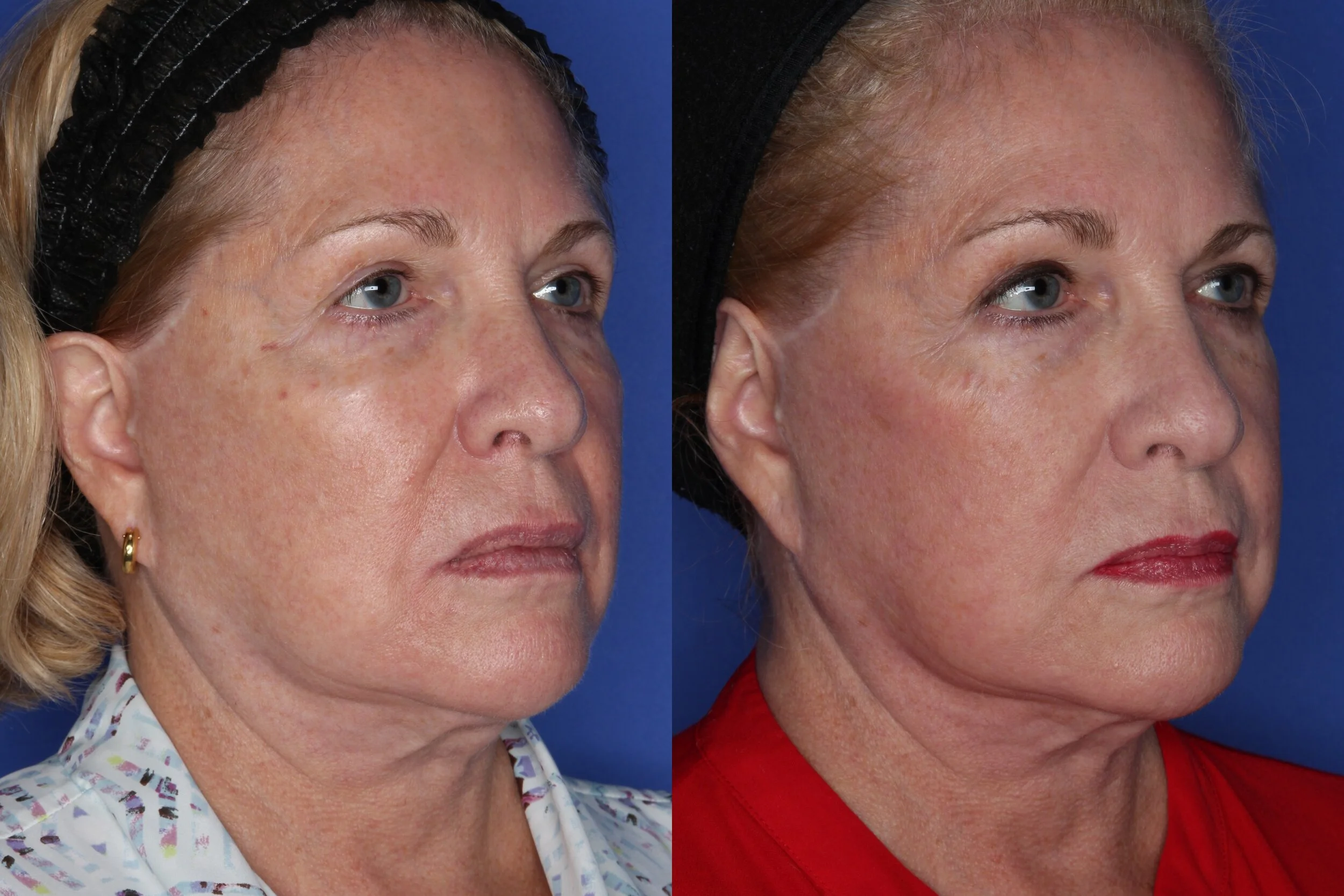 Laser Peel — Golden Glow Medical Spa