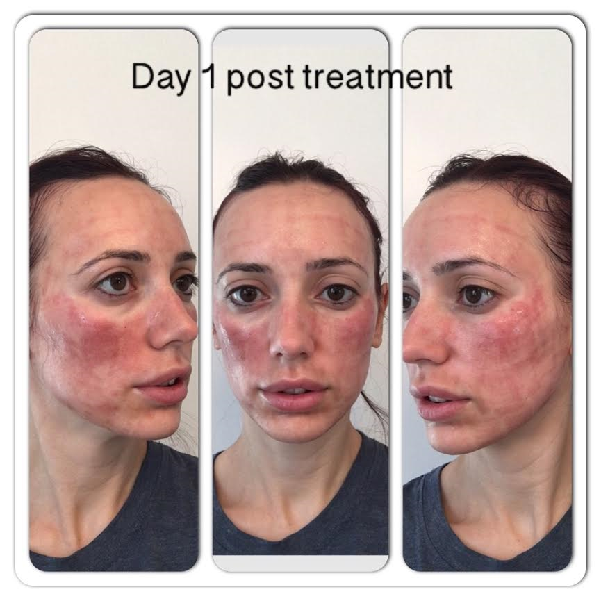 Laser Peel — Golden Glow Medical Spa