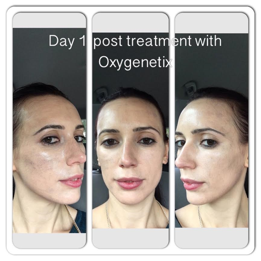 Laser Peel — Golden Glow Medical Spa
