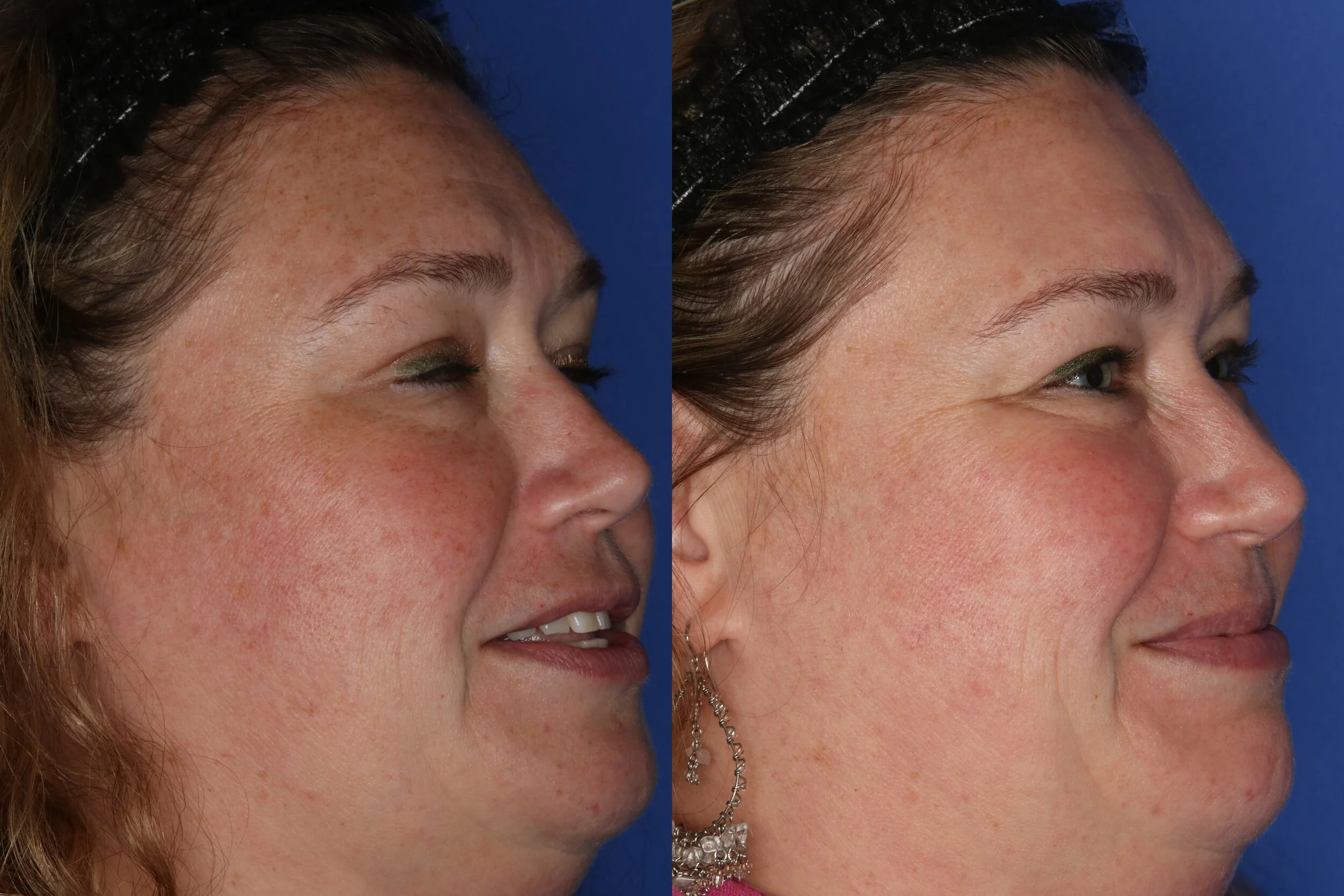 BBL/IPL — Golden Glow Medical Spa