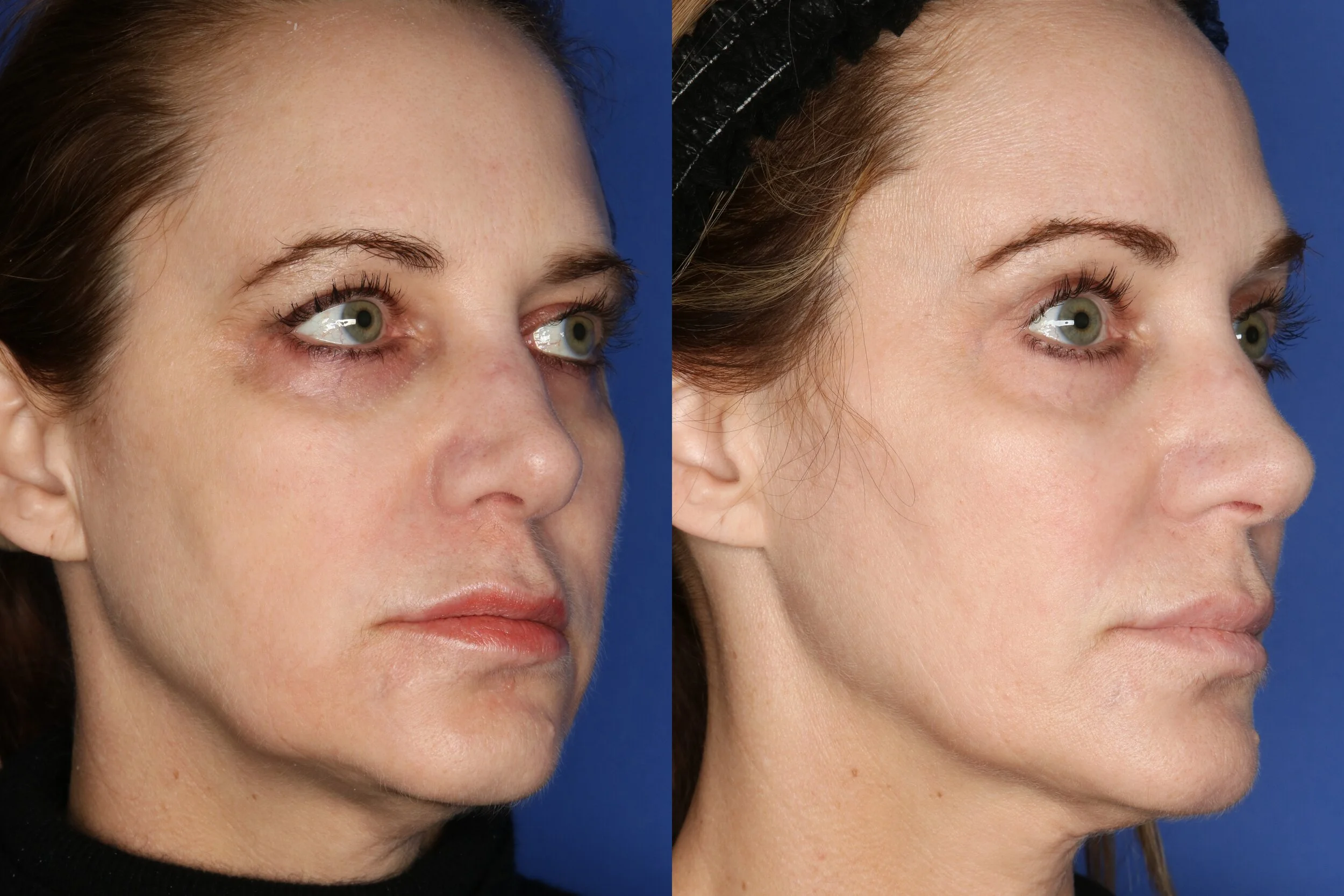 Thread Lift — Golden Glow Medical Spa