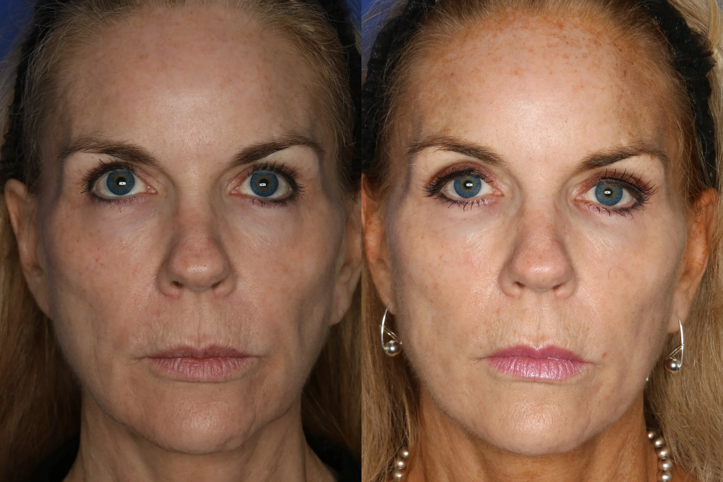 Thread Lift — Golden Glow Medical Spa