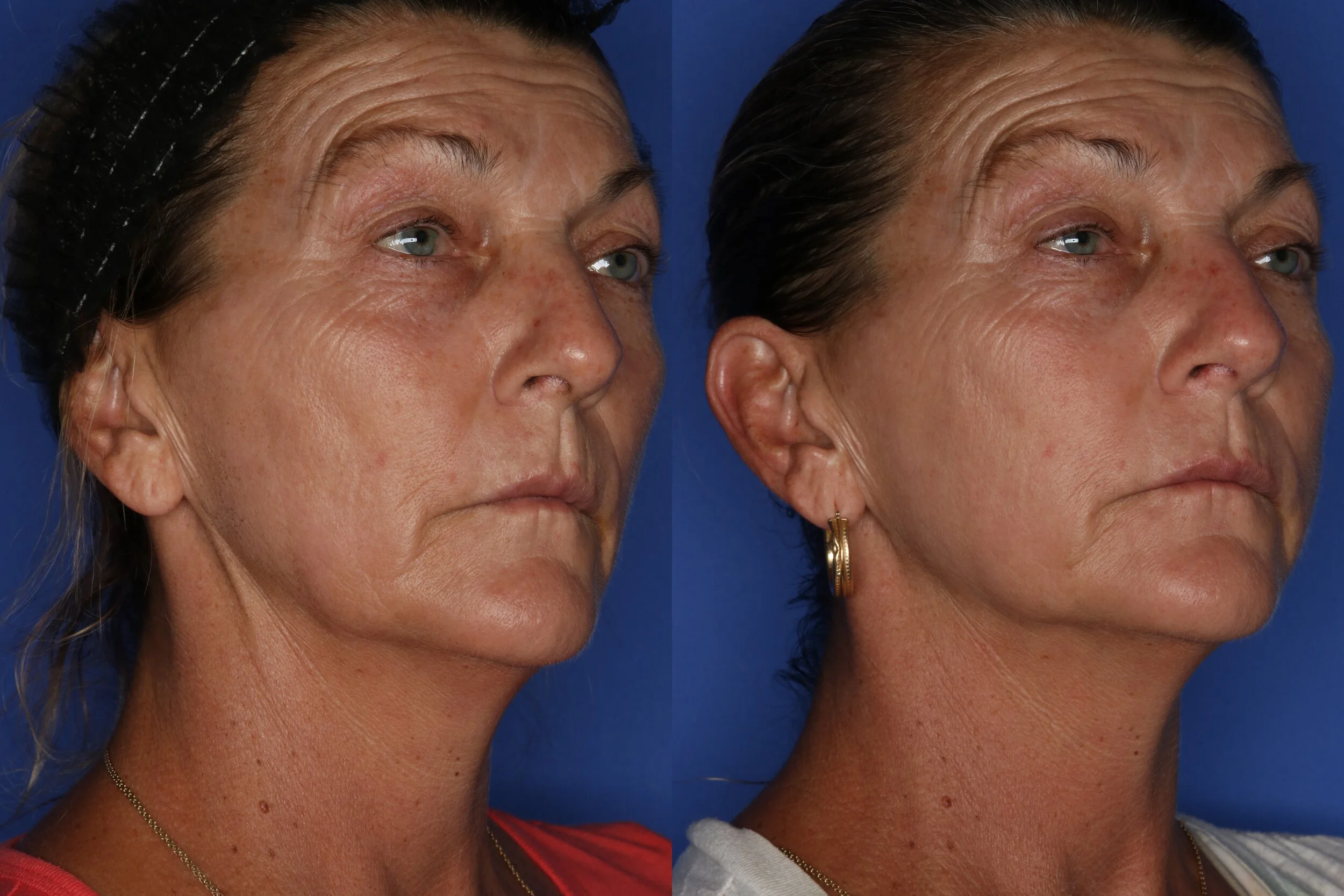 Thread Lift — Golden Glow Medical Spa