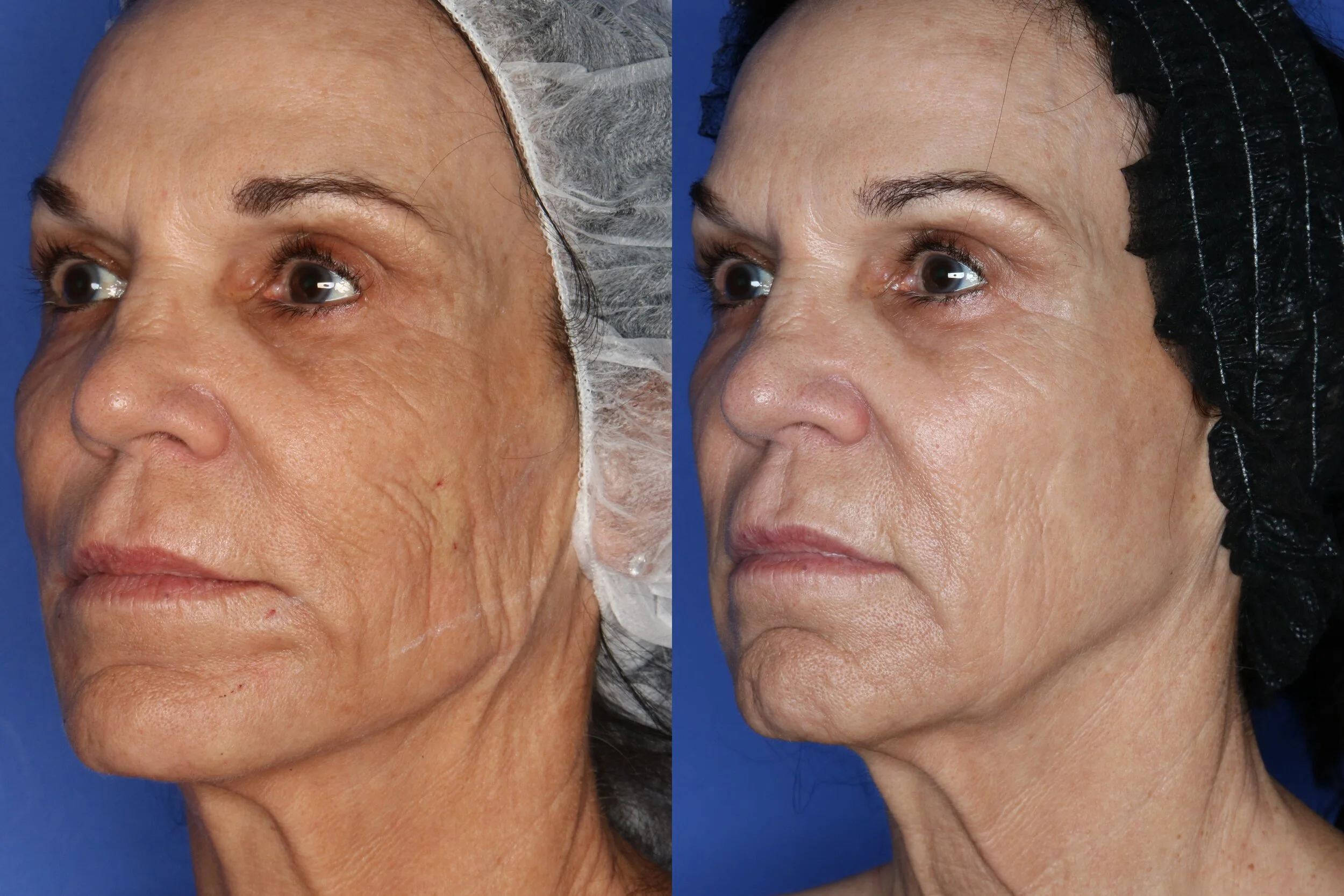 Thread Lift — Golden Glow Medical Spa