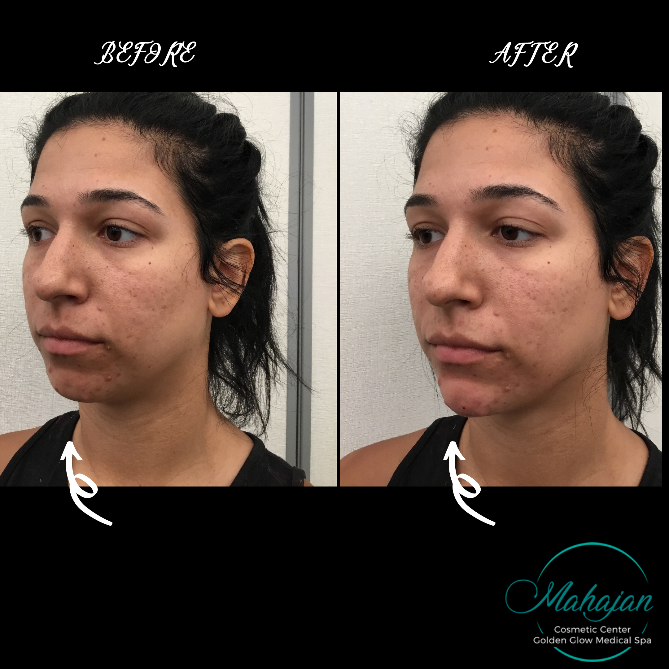 Non-Surgical Chin Enhancement — Mahajan Cosmetic Center