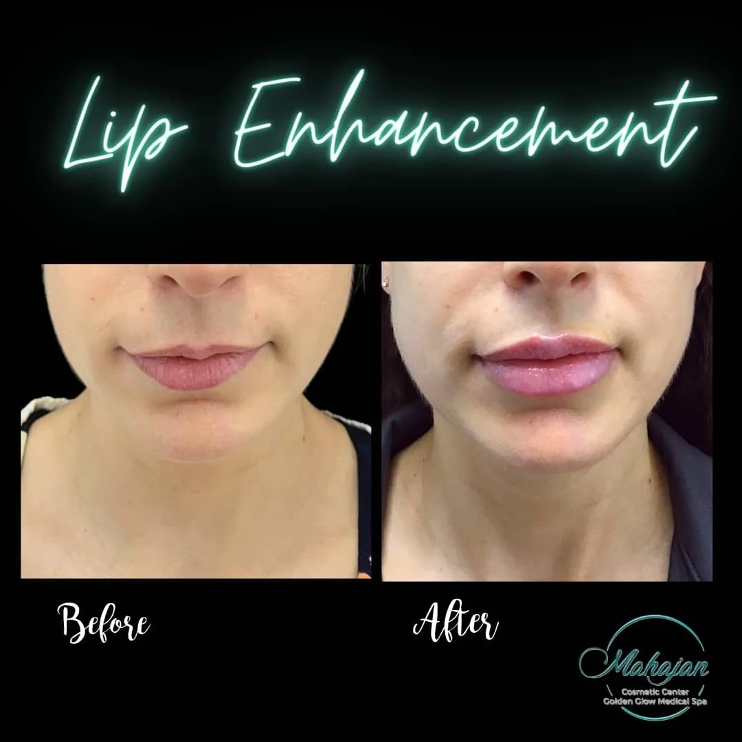 Lip Augmentation/balancing — Mahajan Cosmetic Center
