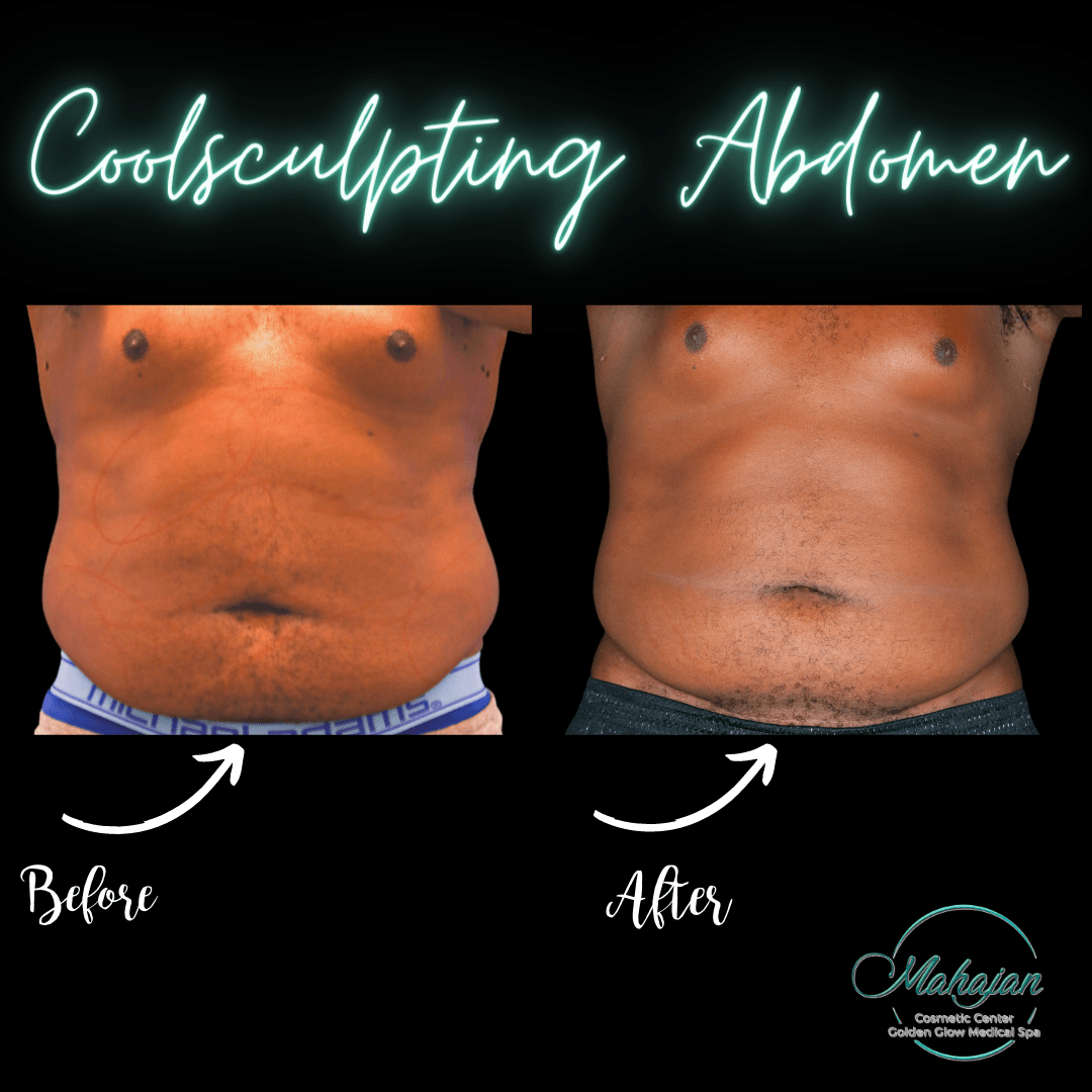 Coolsculpting — Golden Glow Medical Spa