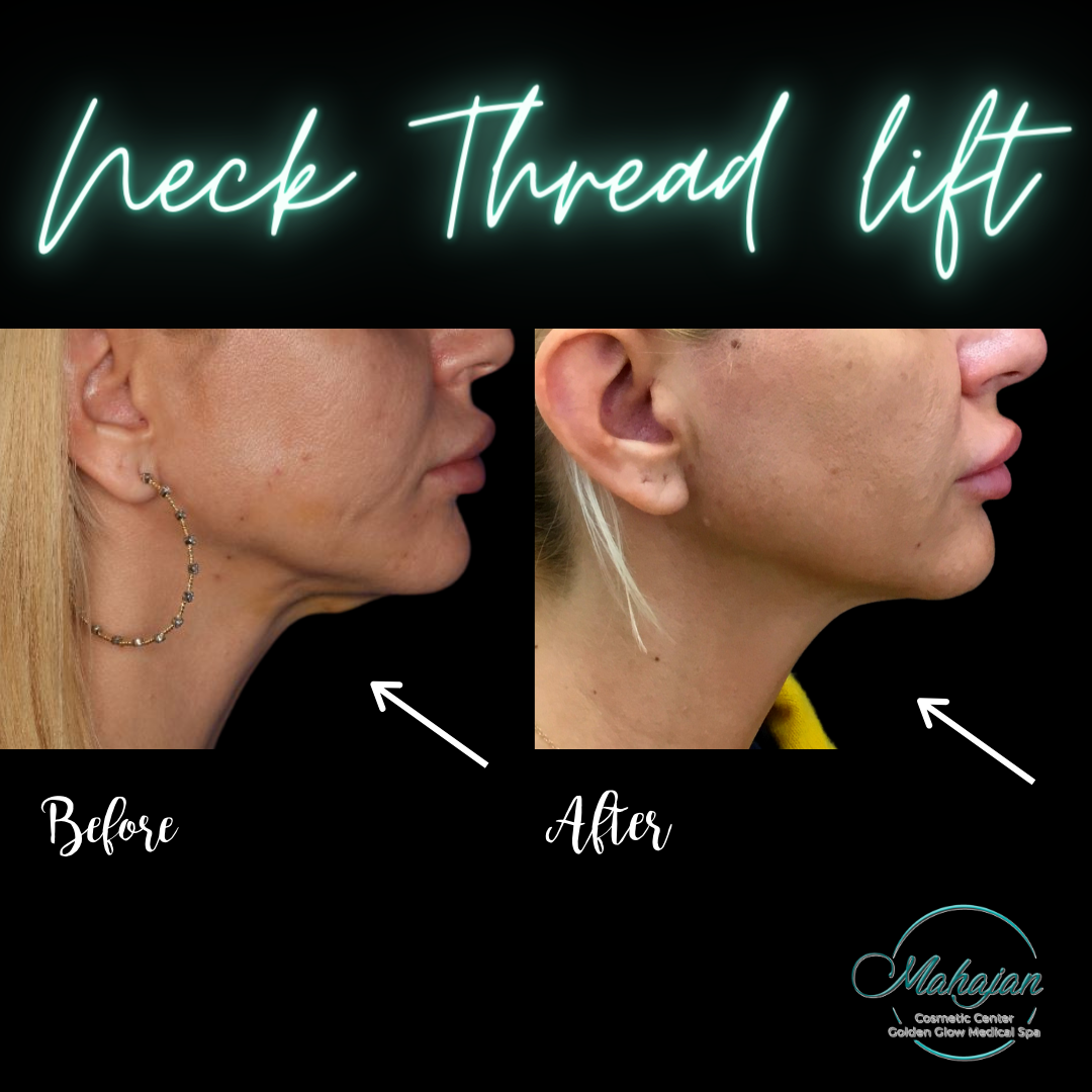 Thread Lift — Golden Glow Medical Spa