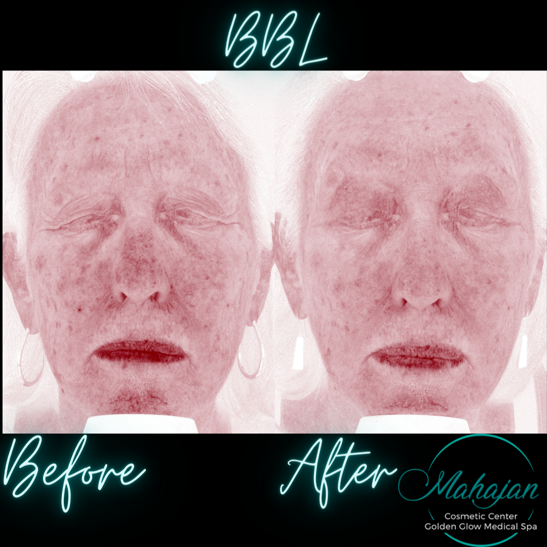 BBL/IPL — Golden Glow Medical Spa